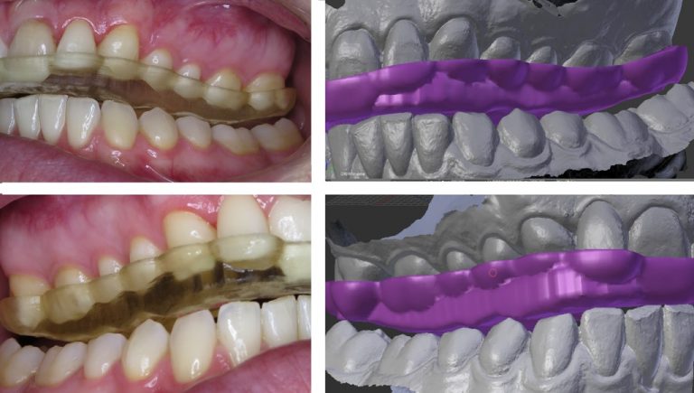 Step One: Occlusal Splints – D3Tool